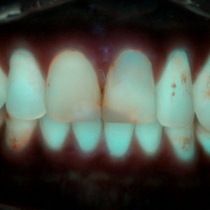 AIOBIO Co., Ltd. : Clinic Case - Revolutionizing Dental Care with Biofluorescence-Led ...