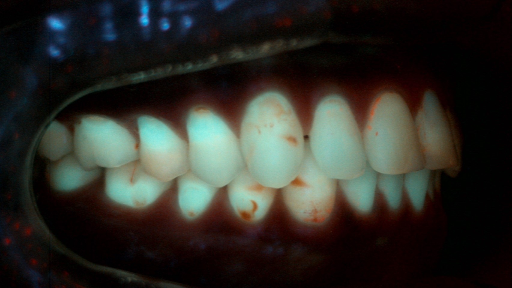 (주)아이오바이오 : Surface Caries