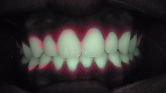 AIOBIO Co., Ltd. : Qray technology - Revolutionizing Dental Care with Biofluorescence-Led ...